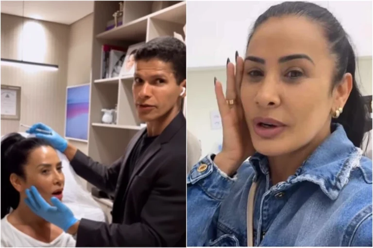 Scheila Carvalho faz reversão de procedimento estético e mostra o resultado